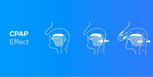 CPAP vs. BiPAP: What's the Difference? (Spring 2023)